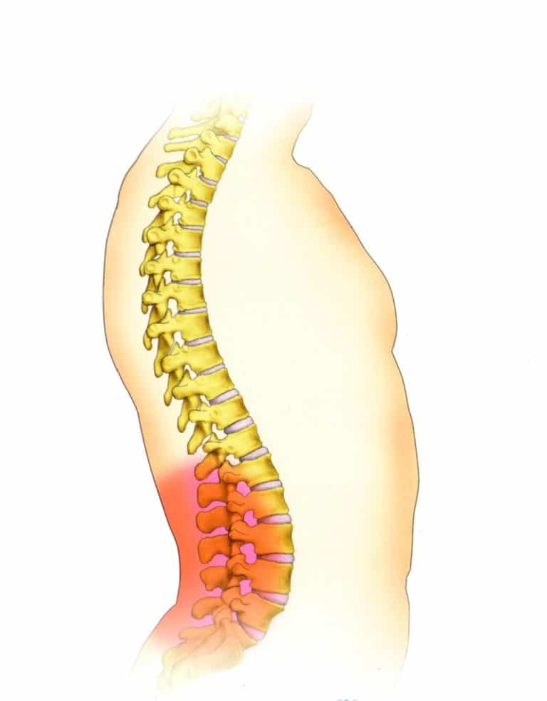 mal de dos: causes, symptômes, comment soulager les douleurs