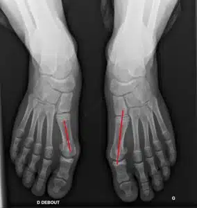 l'hallux valgus Stades d’évolution : léger, modéré, sévère
