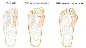 l'hallux valgus Stades d’évolution : léger, modéré, sévère