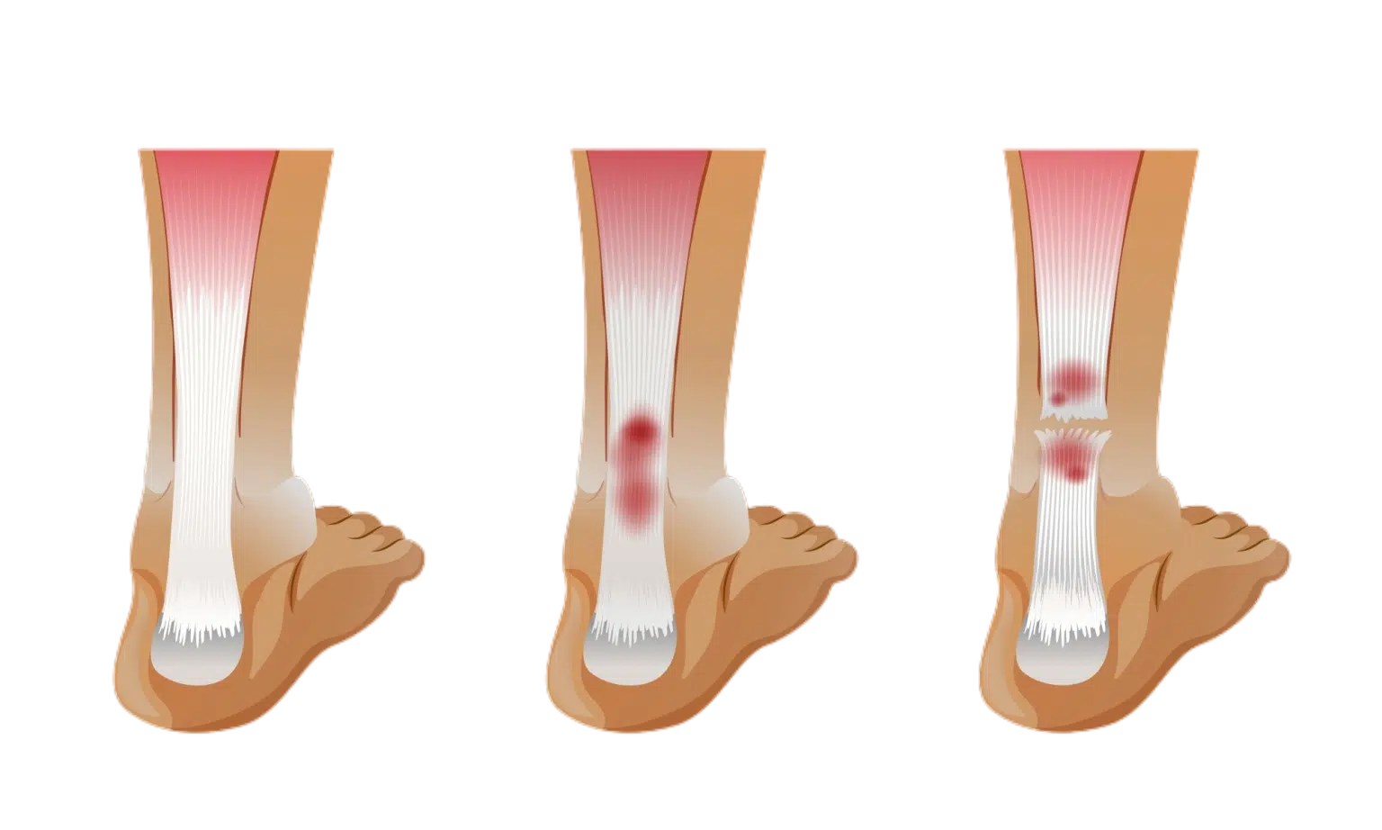 Arthrose du pied : symptômes et solutions pour soulager la douleur