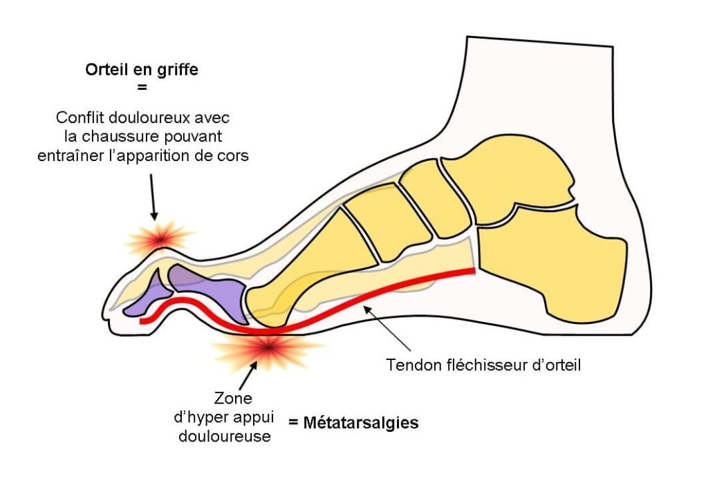 Toutes les causes et solutions pour un orteil en griffe